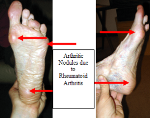 Arthritis Foot Care | Osteoarthritis Treatment | PTI Orthotics Boulder
