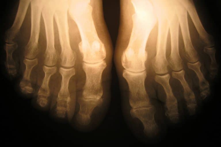 What are Orthotics - PTI Orthotics & Foot Resource Lab