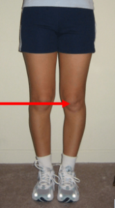 Chrondromalacia Patella | PTI Orthotics Boulder Longmont