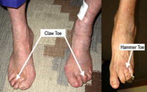 Hammer Toe Care | Claw Toe | PTI Orthotics | Boulder Longmont
