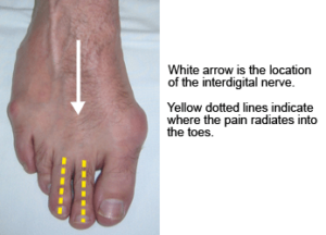 Neuroma | Painful Foot Condition | PTI Orthotics | Boulder Longmont