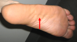 Mid Foot Plantar Fasciitis | Foot Pain | PTI Orthotics | Boulder Longmont