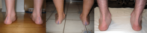 Pronation | Foot Pain | PTI Orthotics | Boulder Longmont CO